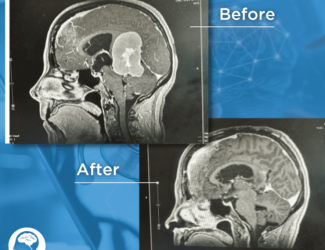 Hidden Cause of Low Back Pain | Denver Spine Specialists